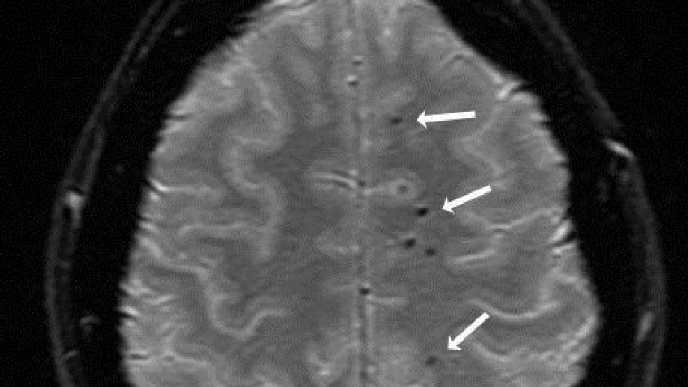 URMC research opens door for a blood test to diagnose concussion injury ...
